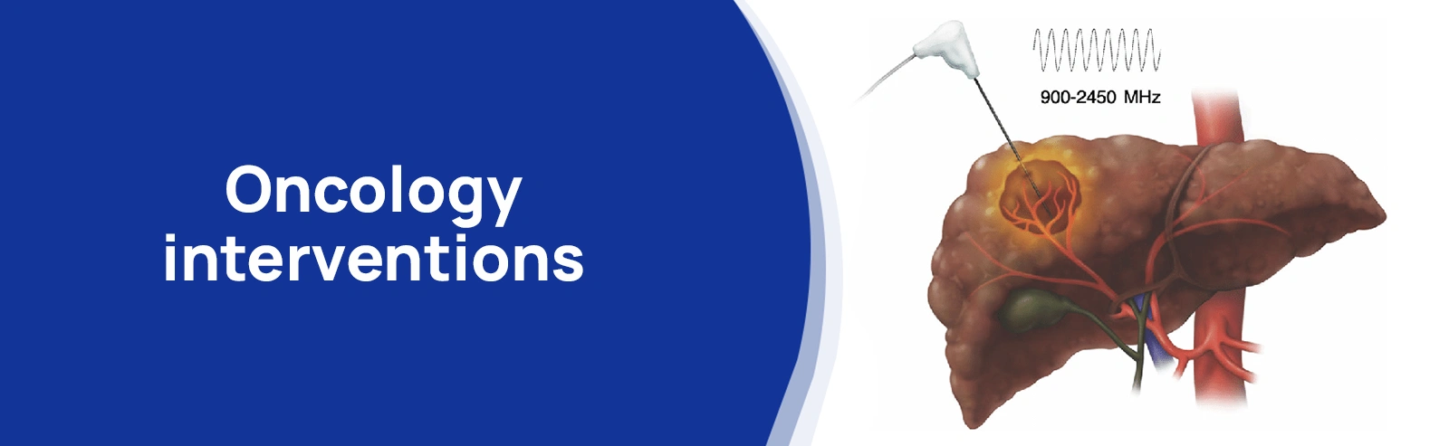 Advanced Oncology Interventions: One Stop Vascular Solutions